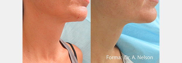 The Ageless clinic - Face Ironing Treatment