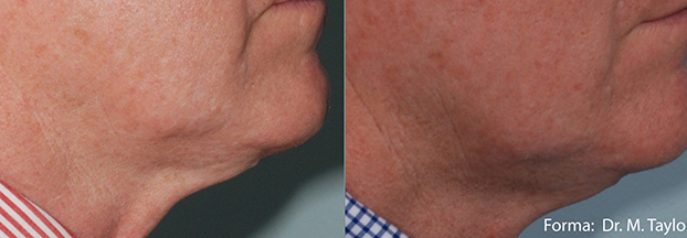 The Ageless clinic - Face Ironing Treatment