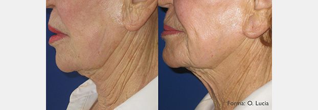 The Ageless clinic - Face Ironing Treatment