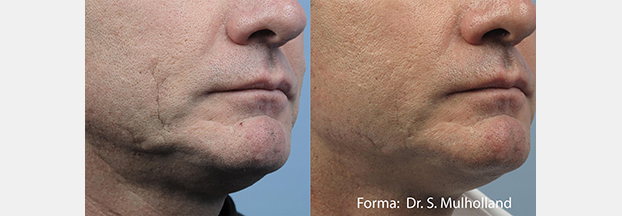 The Ageless clinic - Face Ironing Treatment